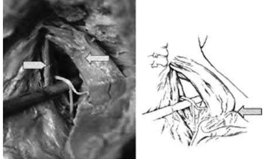 6 posterior view of the dorsal scapular nerve piercing the