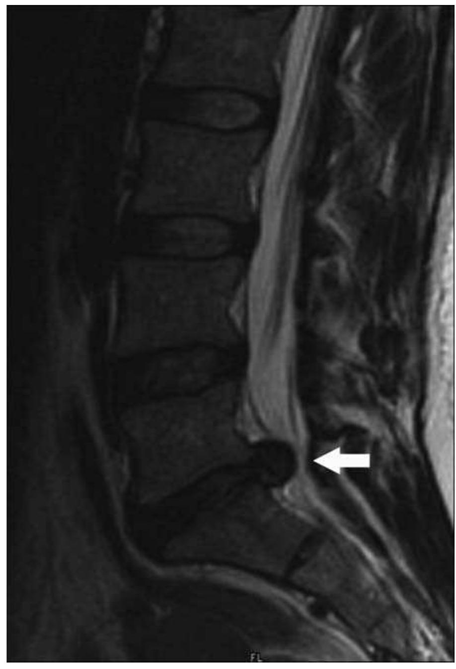 3 herniated disc. arrow indicates retropulsed disc material