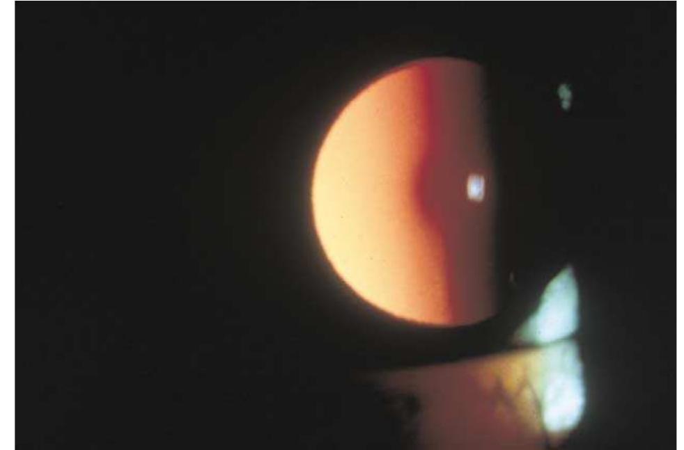 Mild posterior lenticonus causing an abnormal red reflex and