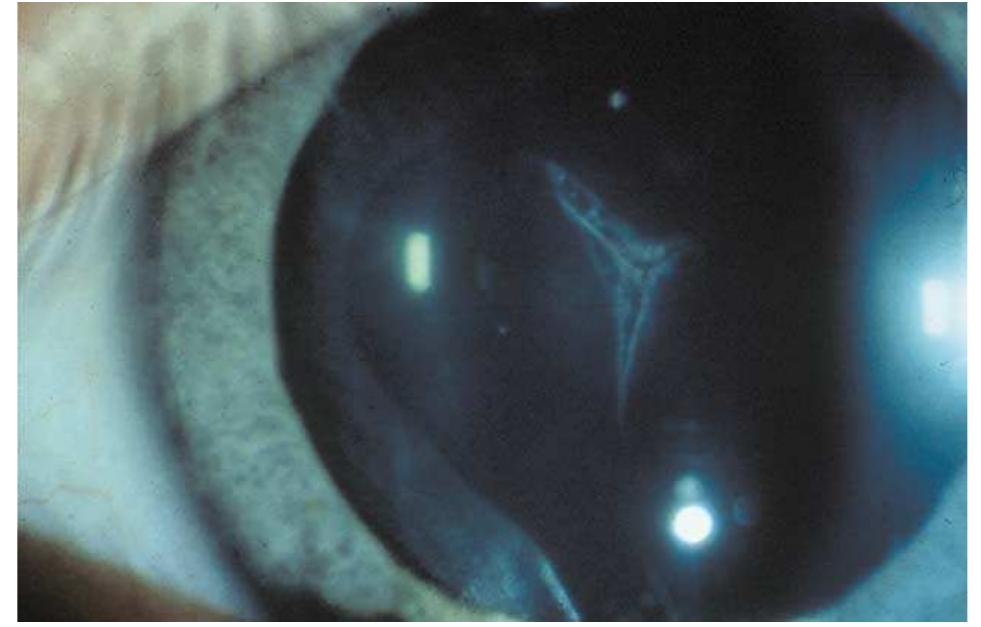 Cataract of the y-shaped sutures, more pro- nounced on two