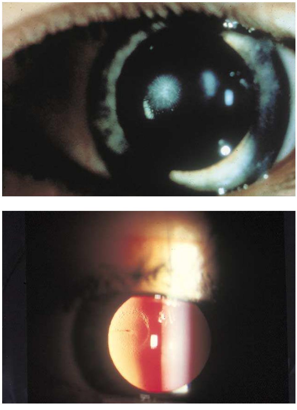 Tion of congenital cataracts with phpv and traction of the