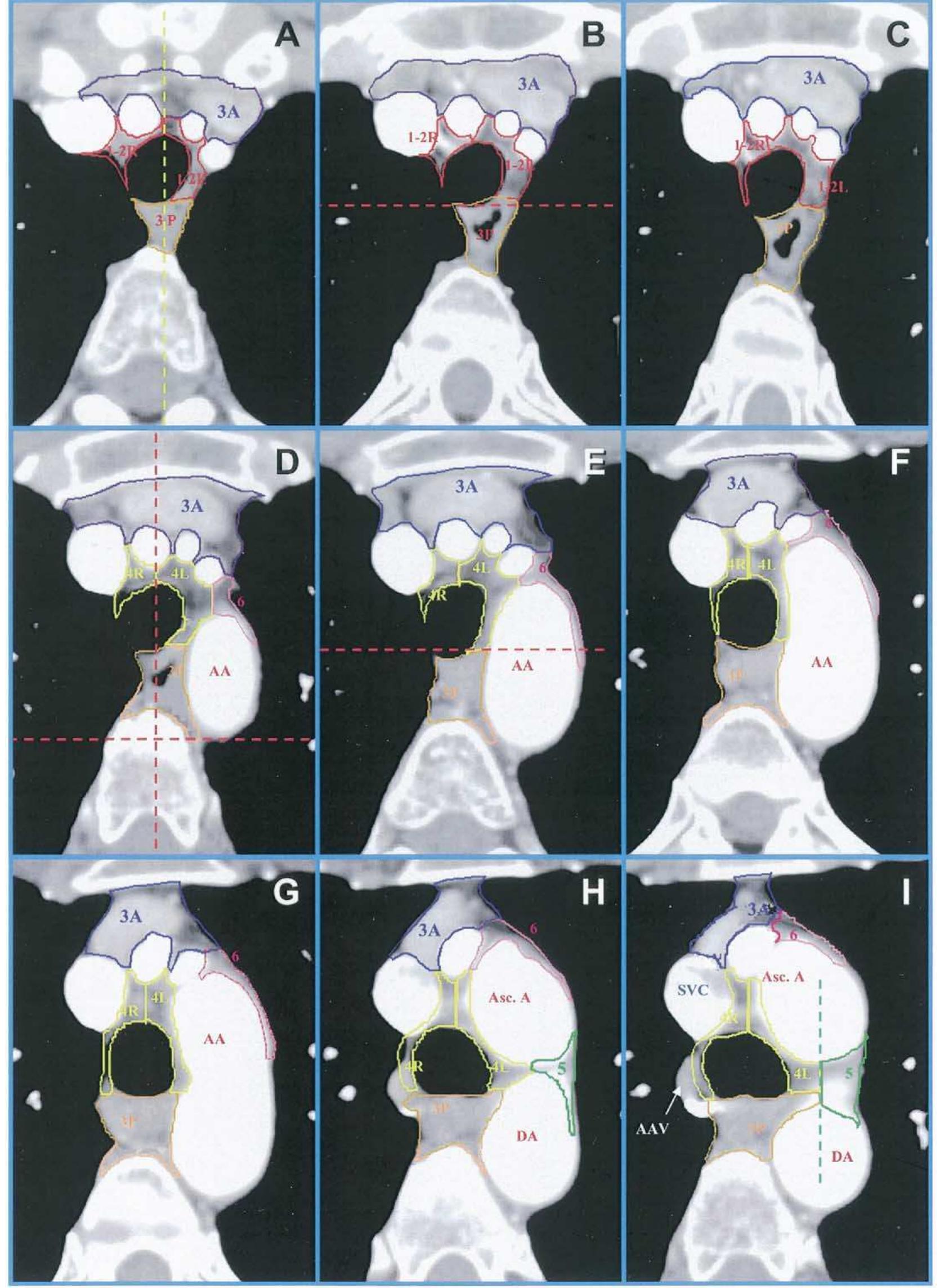 (PDF) CT-based definition of thoracic lymph node stations: An atlas ...