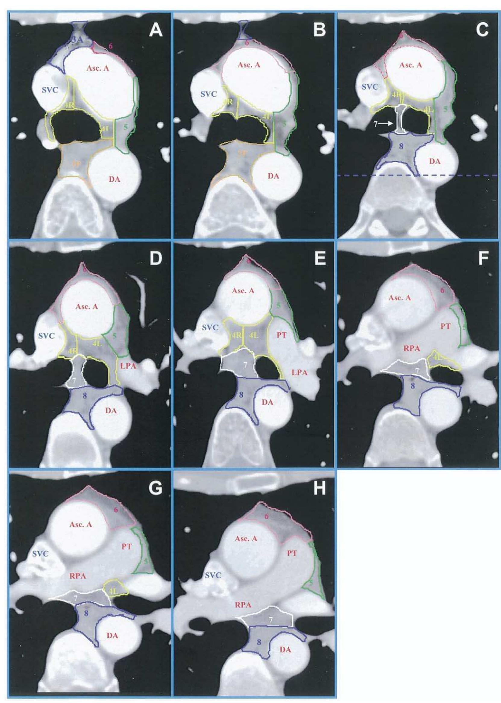 (PDF) CT-based definition of thoracic lymph node stations: An atlas ...