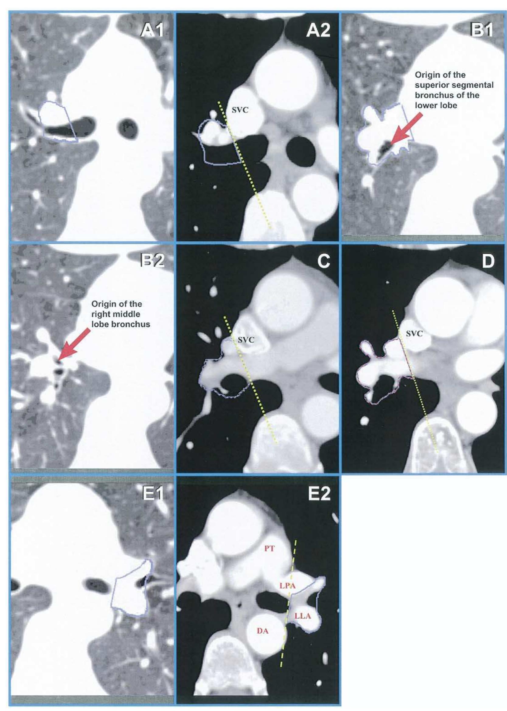 (PDF) CT-based definition of thoracic lymph node stations: An atlas ...