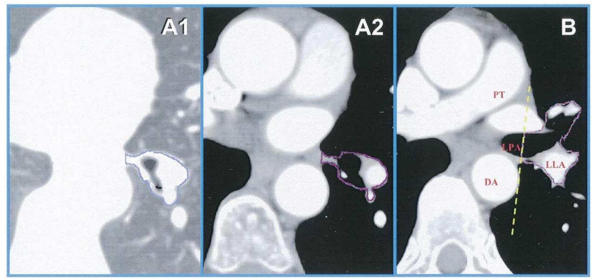(PDF) CT-based definition of thoracic lymph node stations: An atlas ...