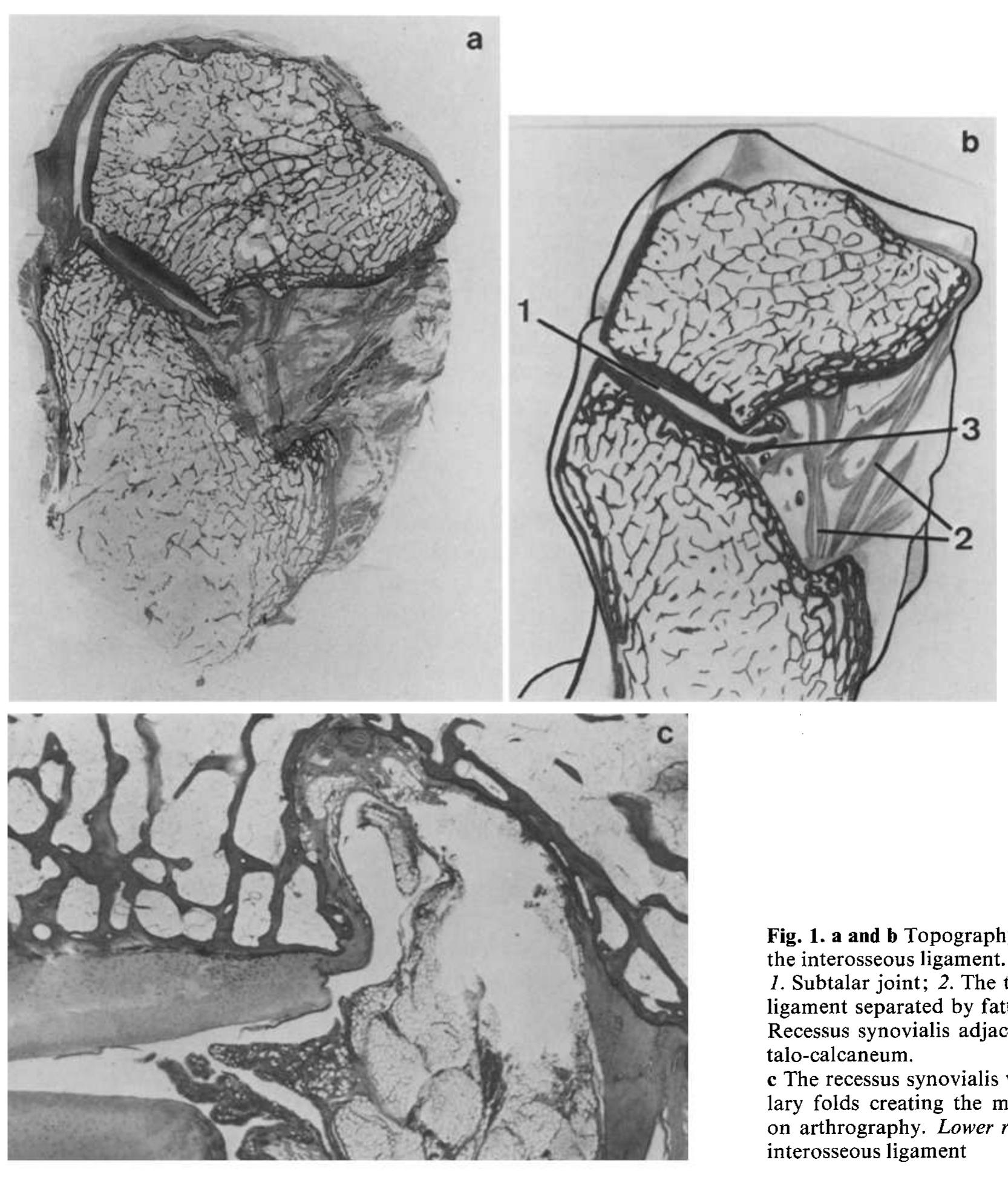 Figure 1 - from The sinus tarsi syndrome
