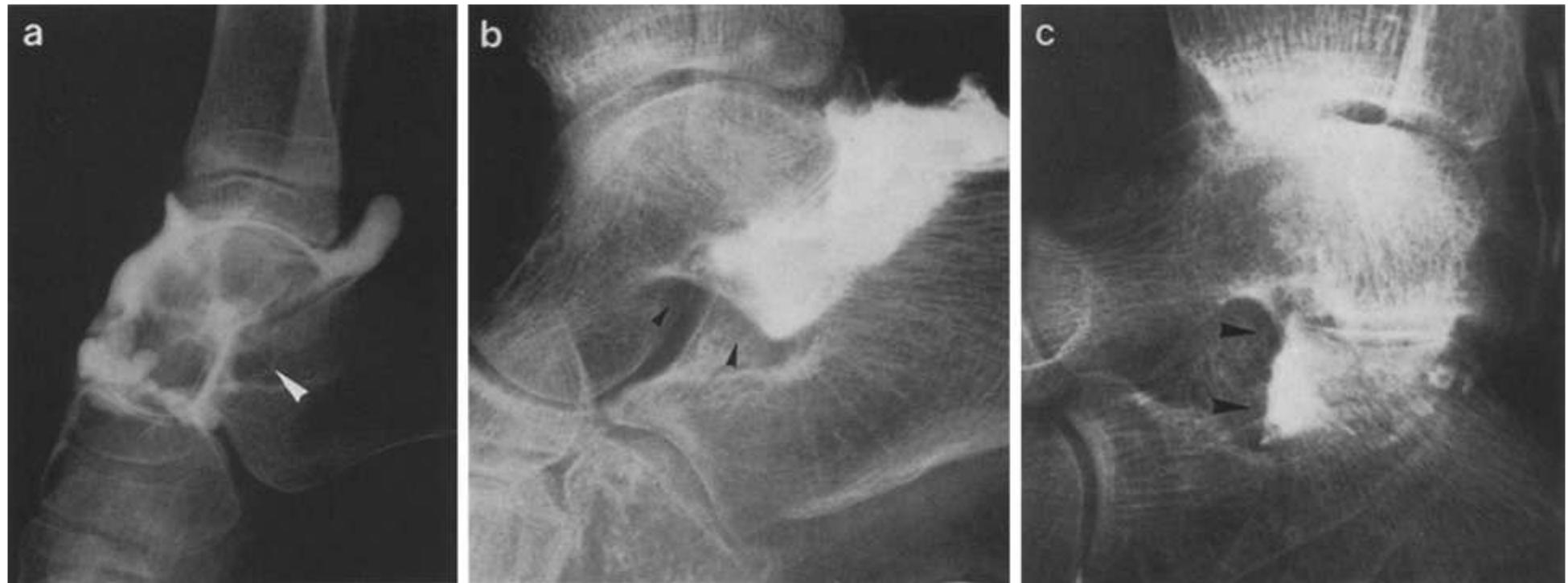 A—c. arthrography of the subtalar joint in chronic sinus