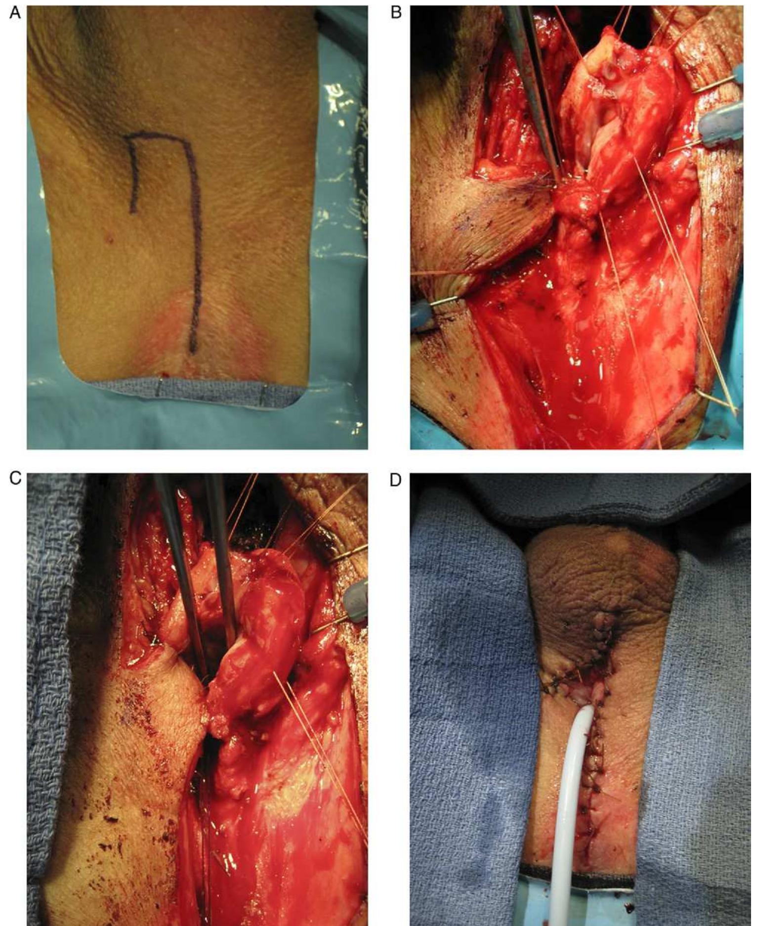 Figure 1 - from The “7-Flap” Perineal Urethrostomy