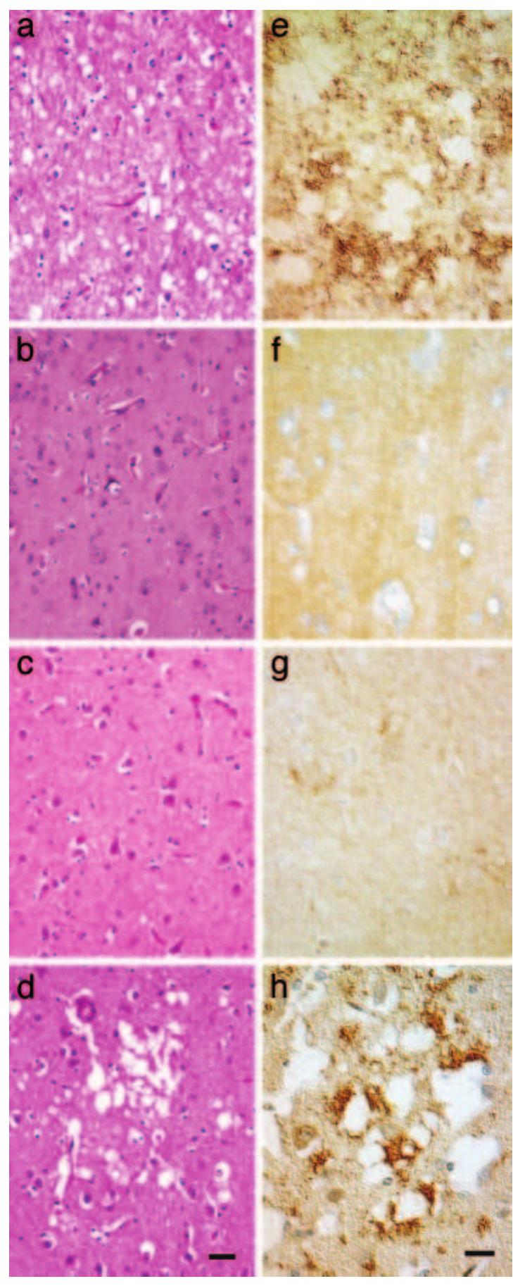 Routine histology and prps ihc on brain sections of two cjd