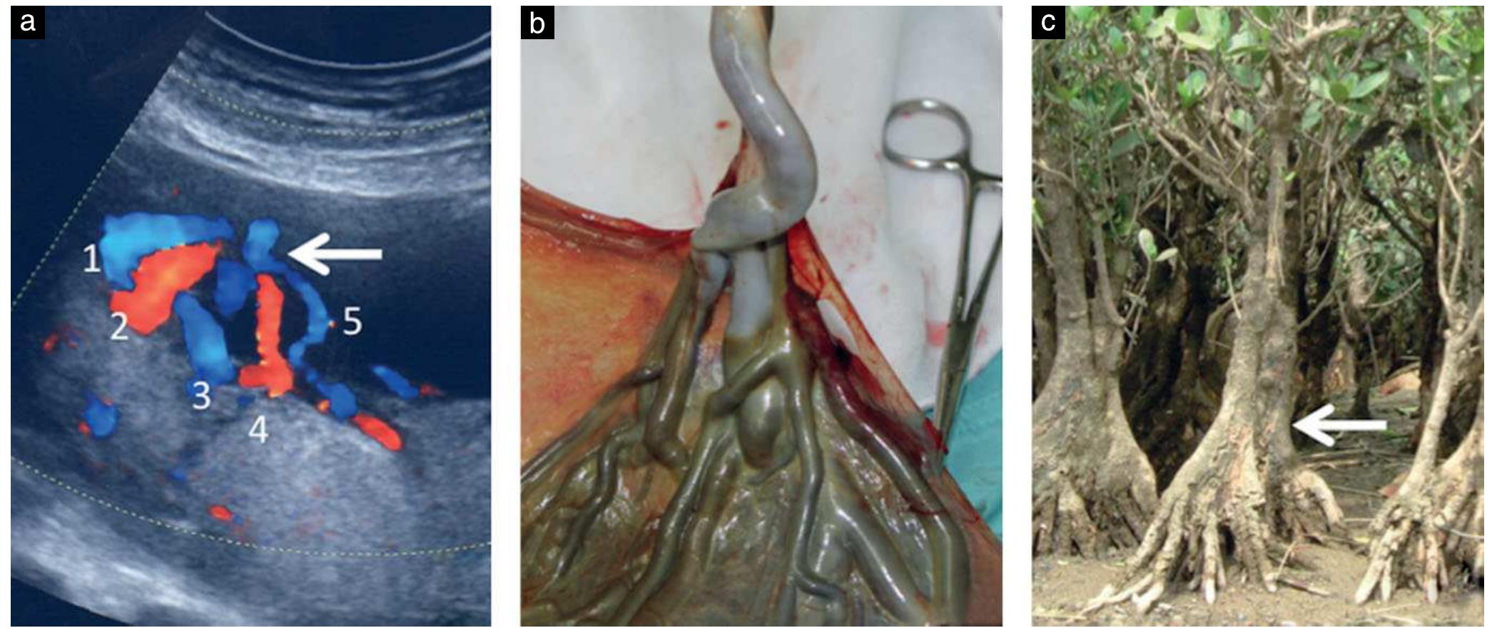 Figure 5 - from Normal intracranial translucency and