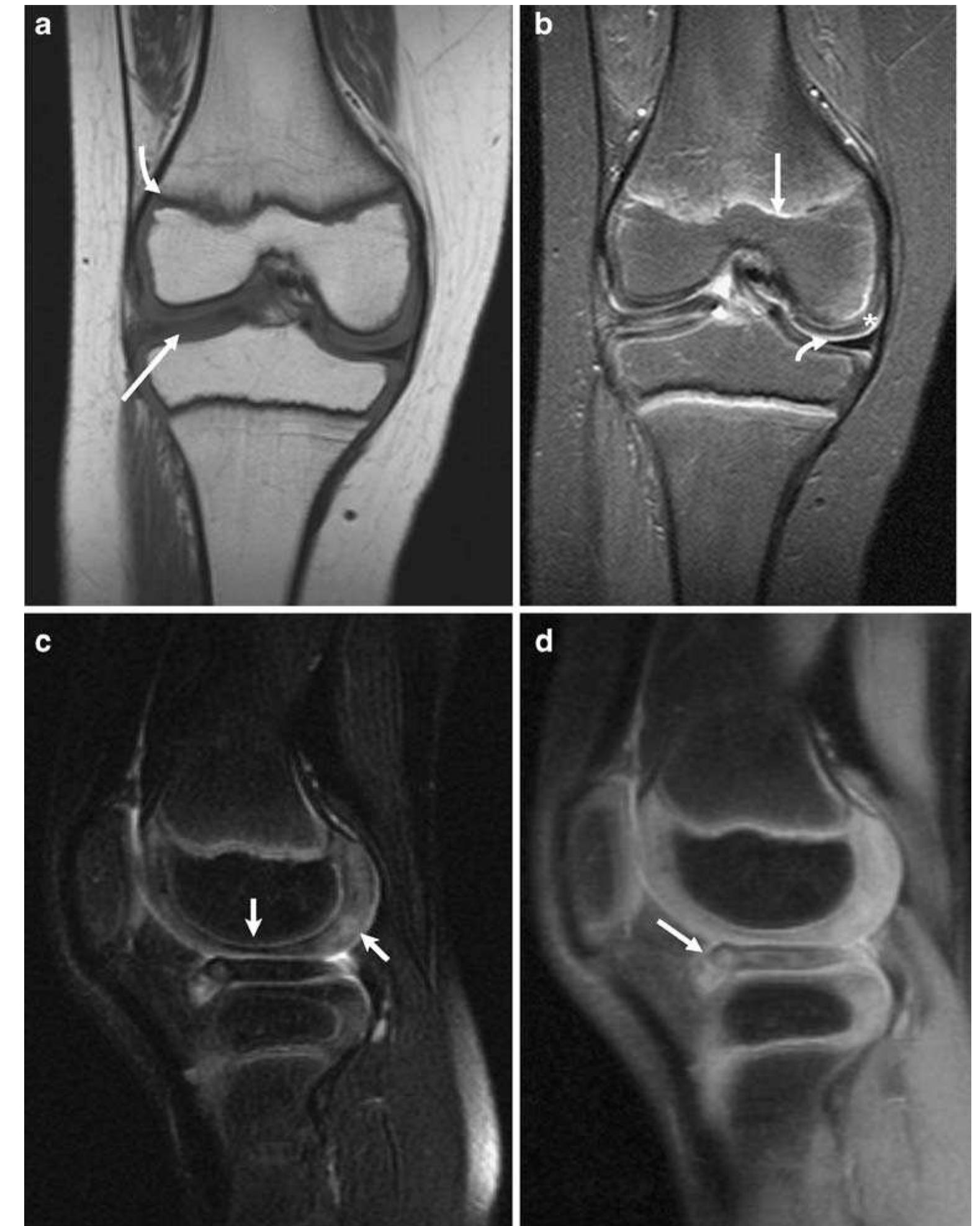 A 7-year-old girl with discoid lateral meniscus of the right
