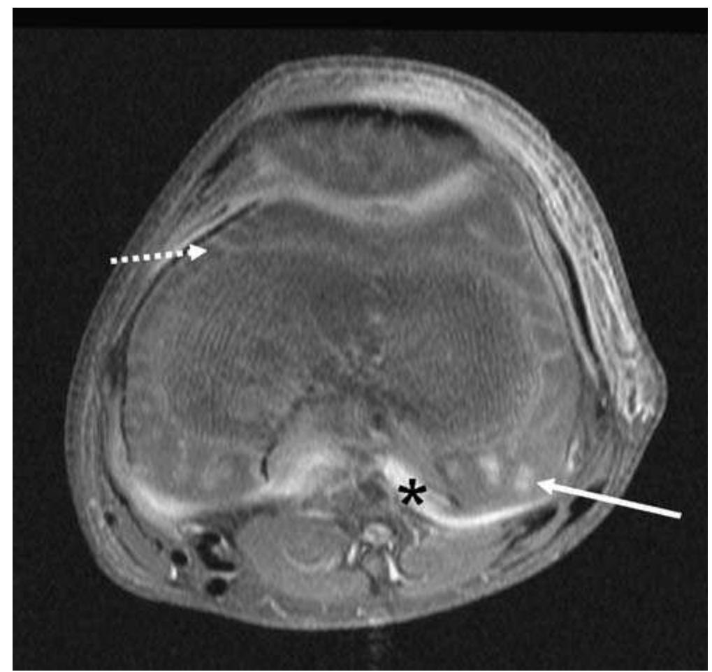 A 2-year-old girl with cellulitis of the knee. axial t1-w