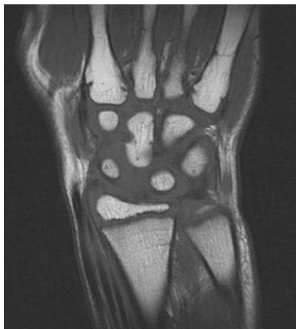 Coronal t1-w image of the hand of an 8-year-old girl