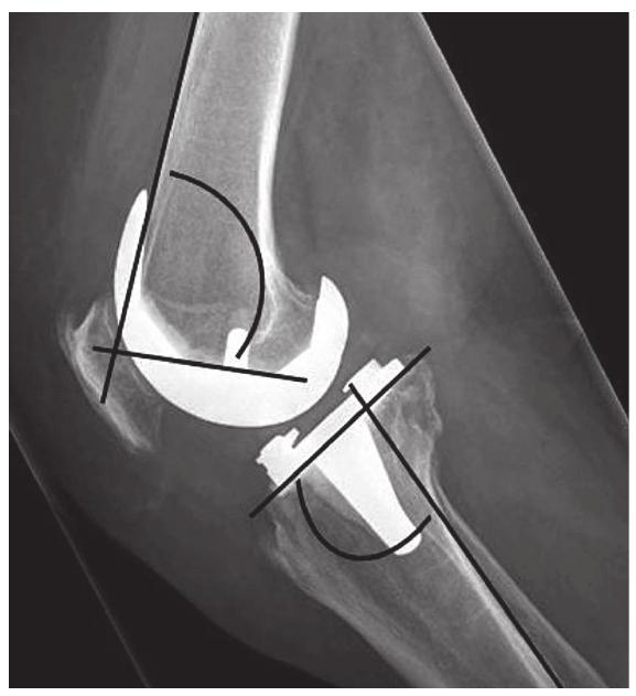 Lateral radiograph showing the lfc and ltc angles. lfc angle