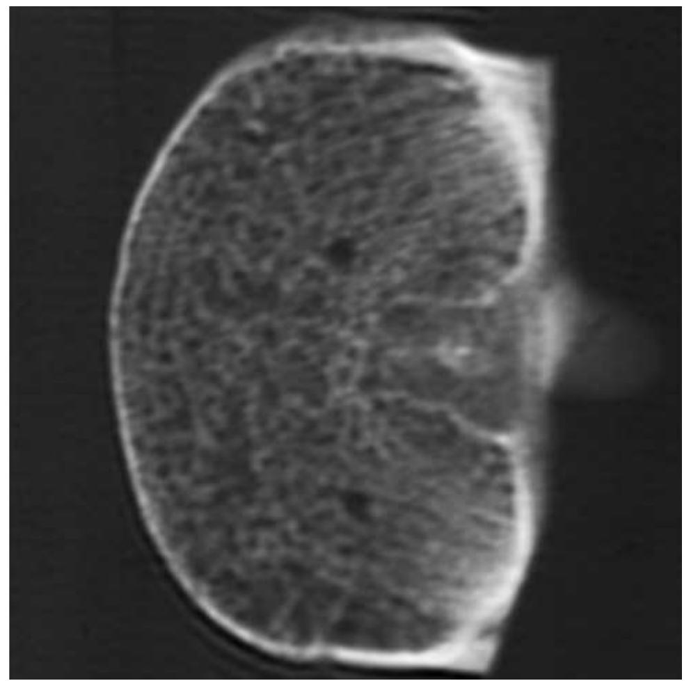 Restored vertebral bone images, using deconvolution and