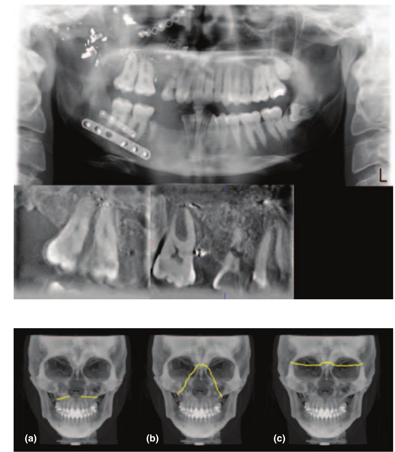 Le fort il fractures a pyramidal or suprazygomatic fracture