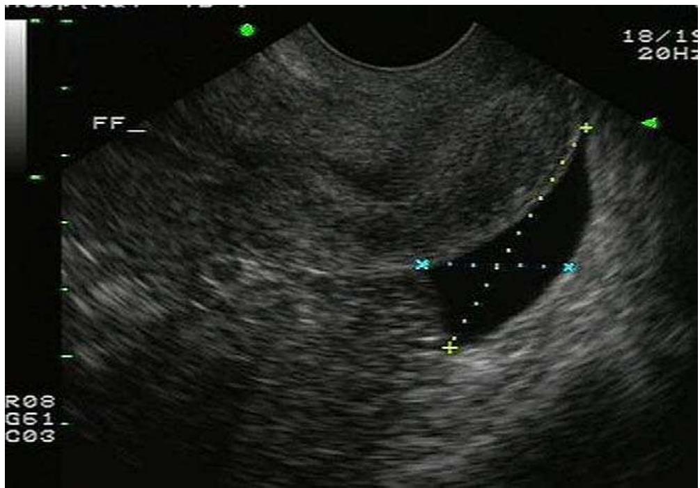 Figure 5 - from Diagnosis and management of ovarian cyst