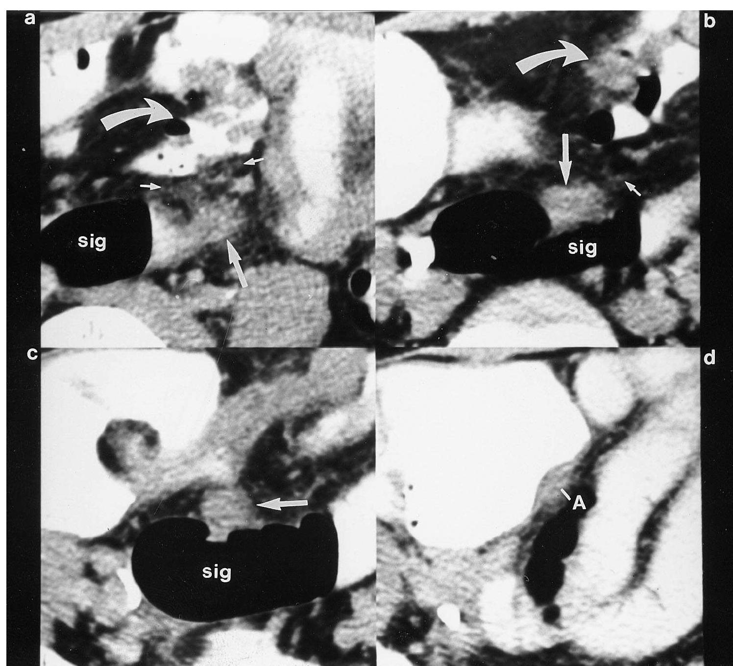 Same patient as in figure 11. left lateral decubitus ct