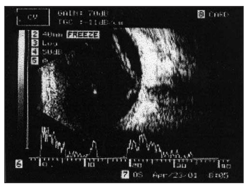 —b-scan shows retinal detachment, giant retinal tear, and