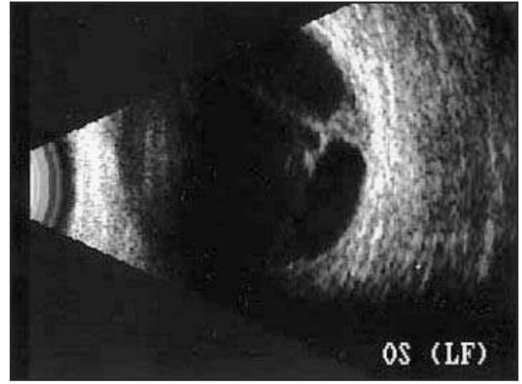 —b-scan showing vitreous hemorrhage, neovascularization of