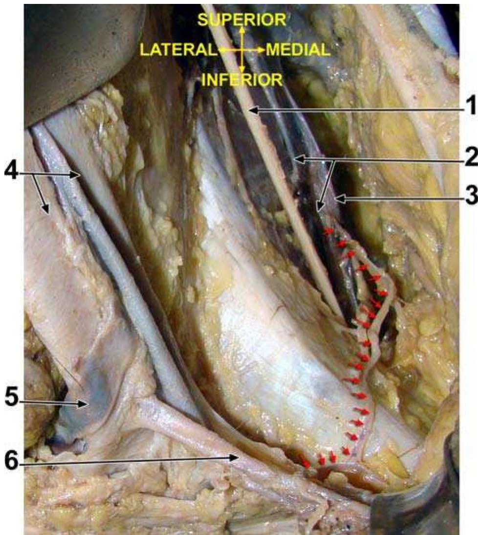 The right side, arterial cmor (type 1.3, arrows the