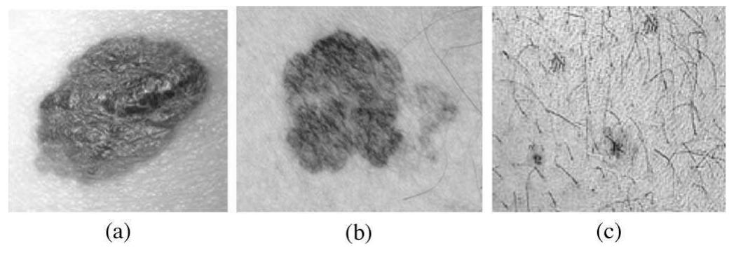 Illustration of (a) typical melanoma, (b) dysplastic nevus,
