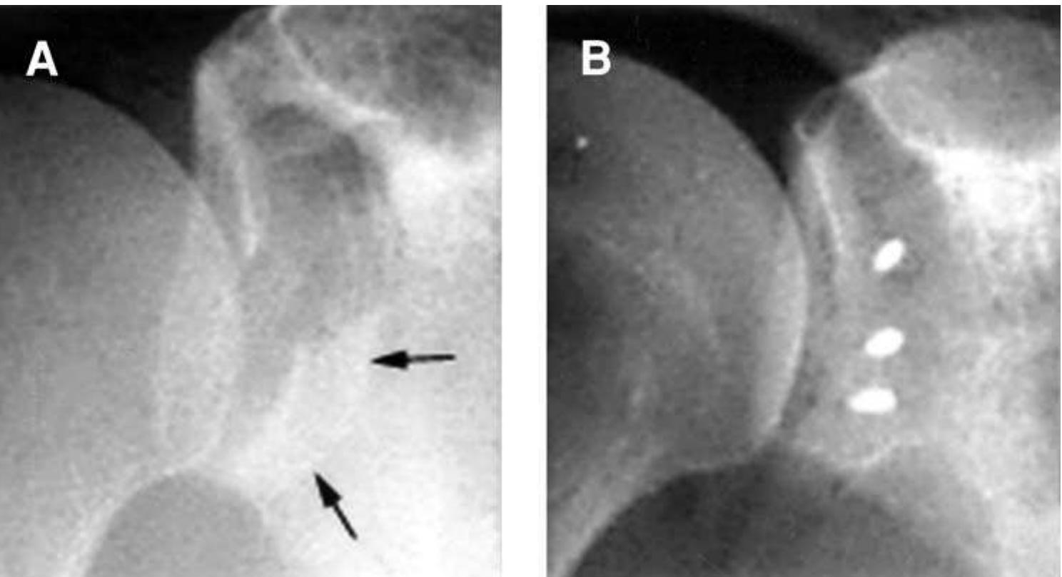 Figure 4 - Arthroscopic approach to acute bony Bankart