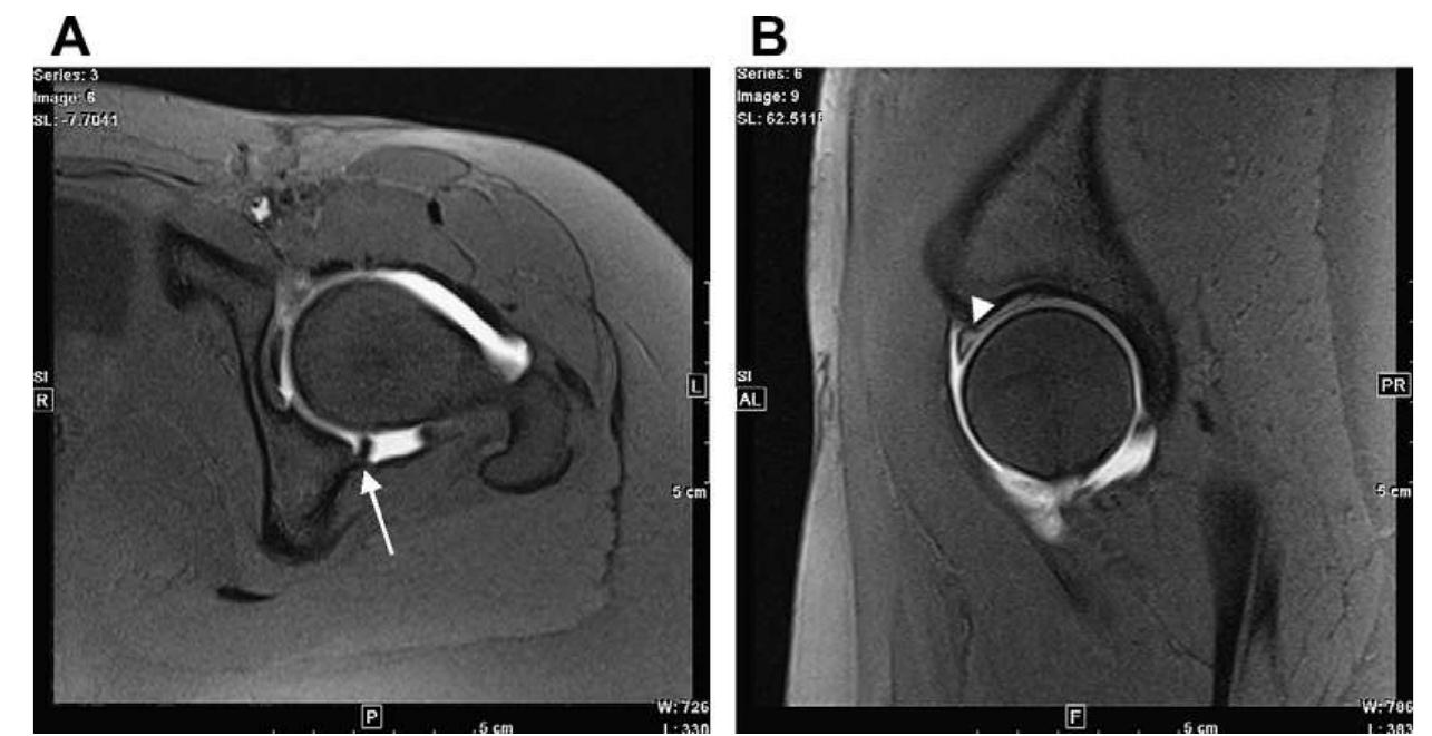 Axial (a) and sagittal (b) t1 fat-suppressed sequences from
