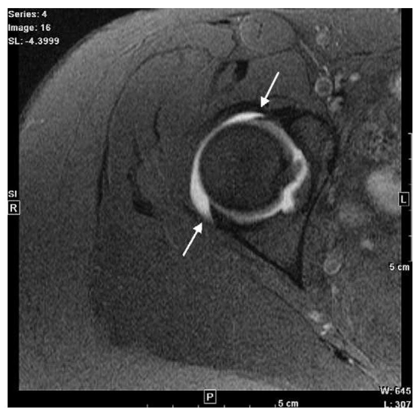 An Axial T1 Fat Suppressed Image From An Mr Arthrogram Of 3960
