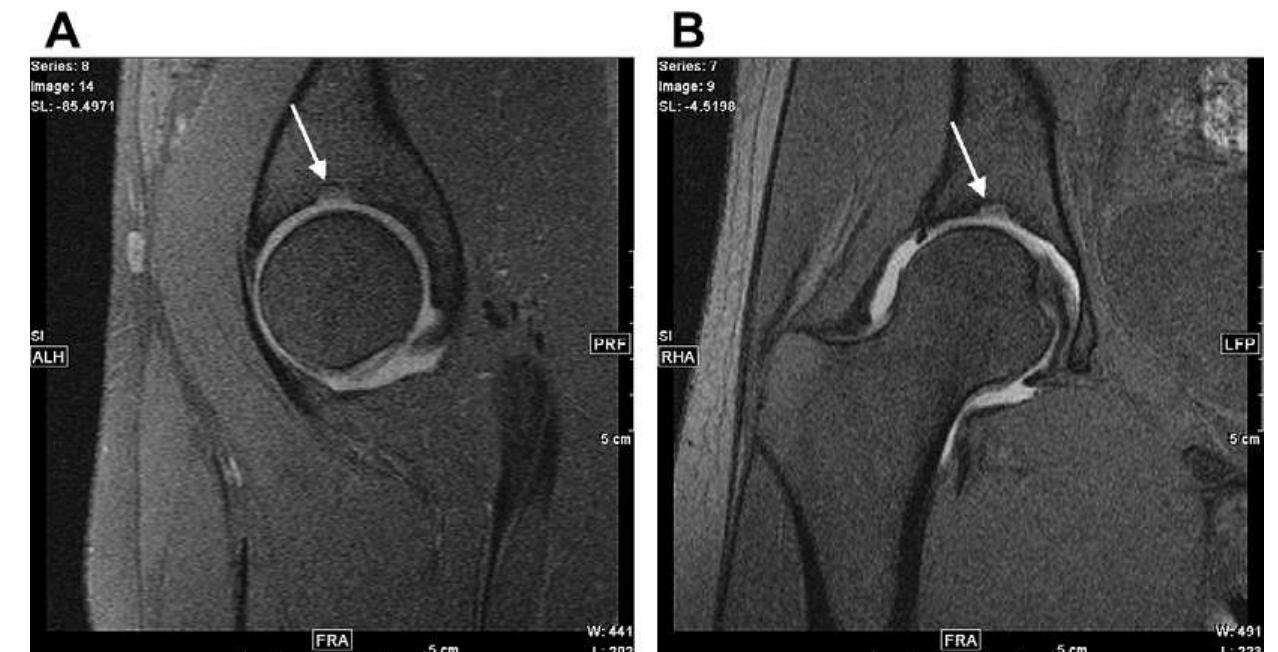 Sagittal (a) and coronal (b) t1 fat-suppressed images from