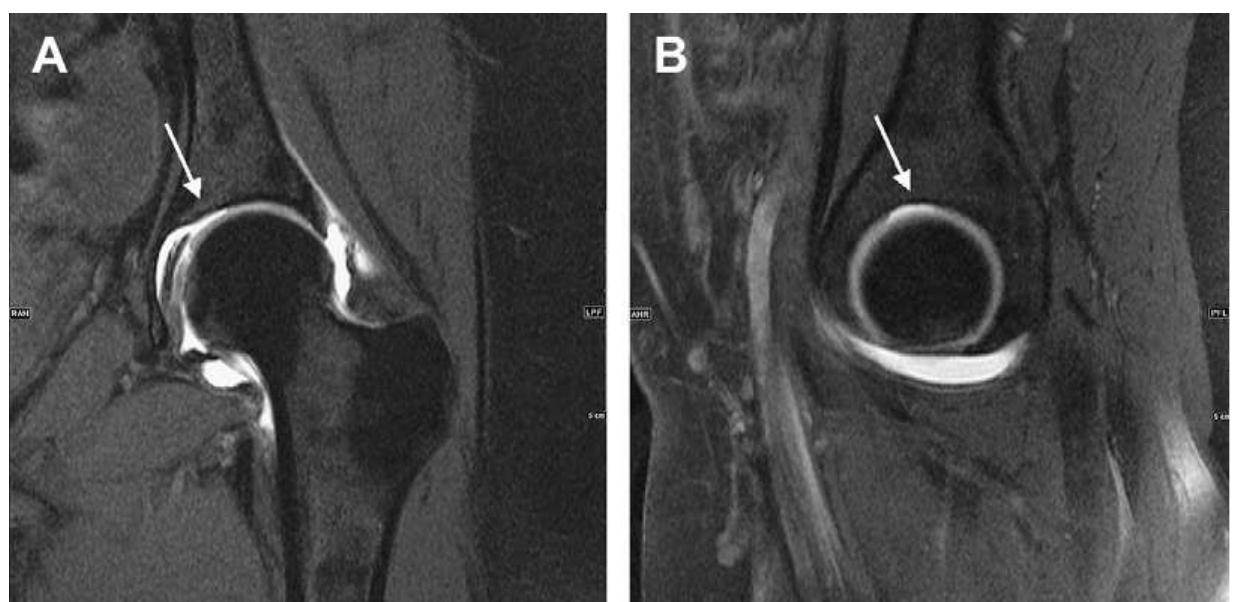 Coronal (a) and sagittal (b) t1 fat-suppressed images from
