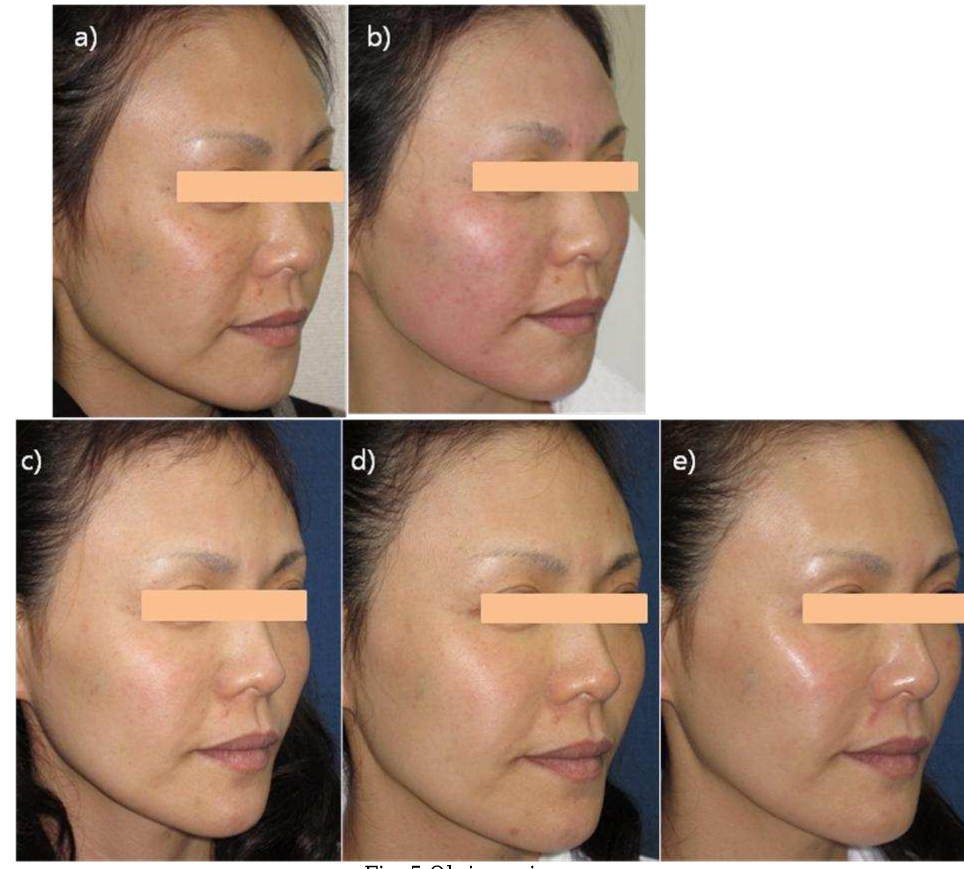 Figure 7 - Thread lift with absorbable monofilament threads