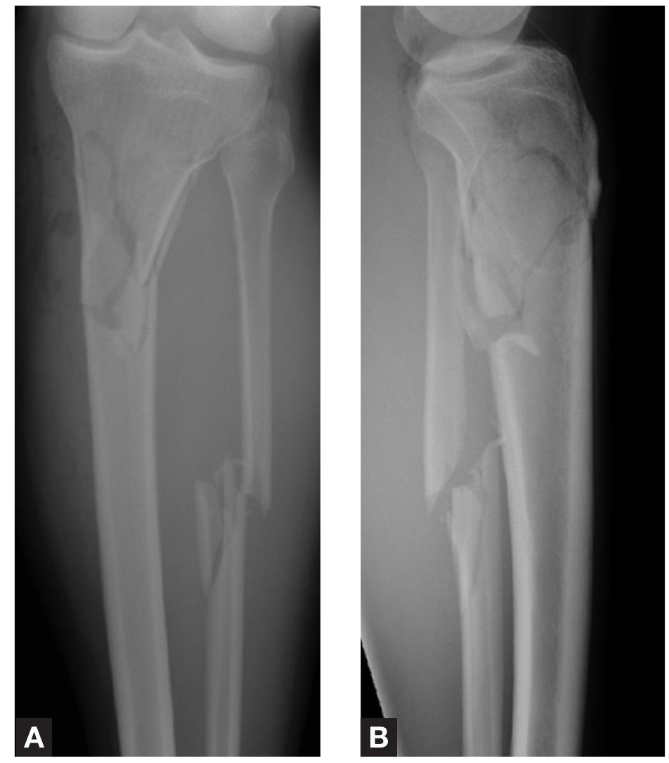 Anteroposterior (a) and lateral (b) radiographs of gustilo