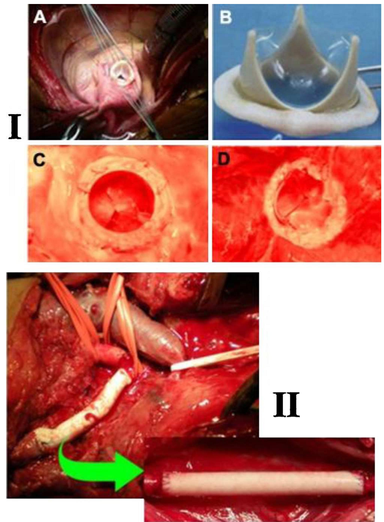 (1) nanocellulose-polyurethane prosthetic heart valve: (a)