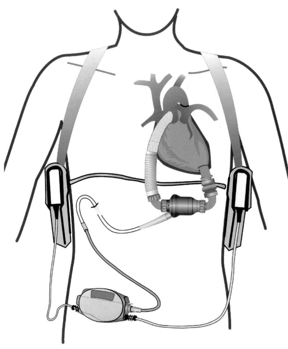 Battery-powered heartmate ii lvad system.