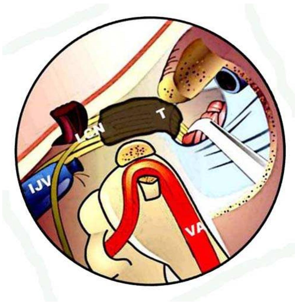 Schematic illustration showing the surgical approach with