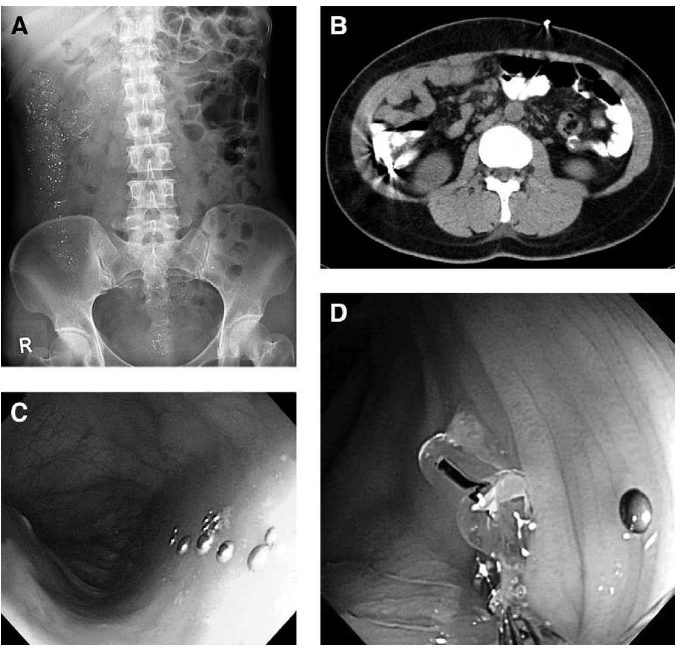 Figure 5 - Types of Colitis Based on Histology