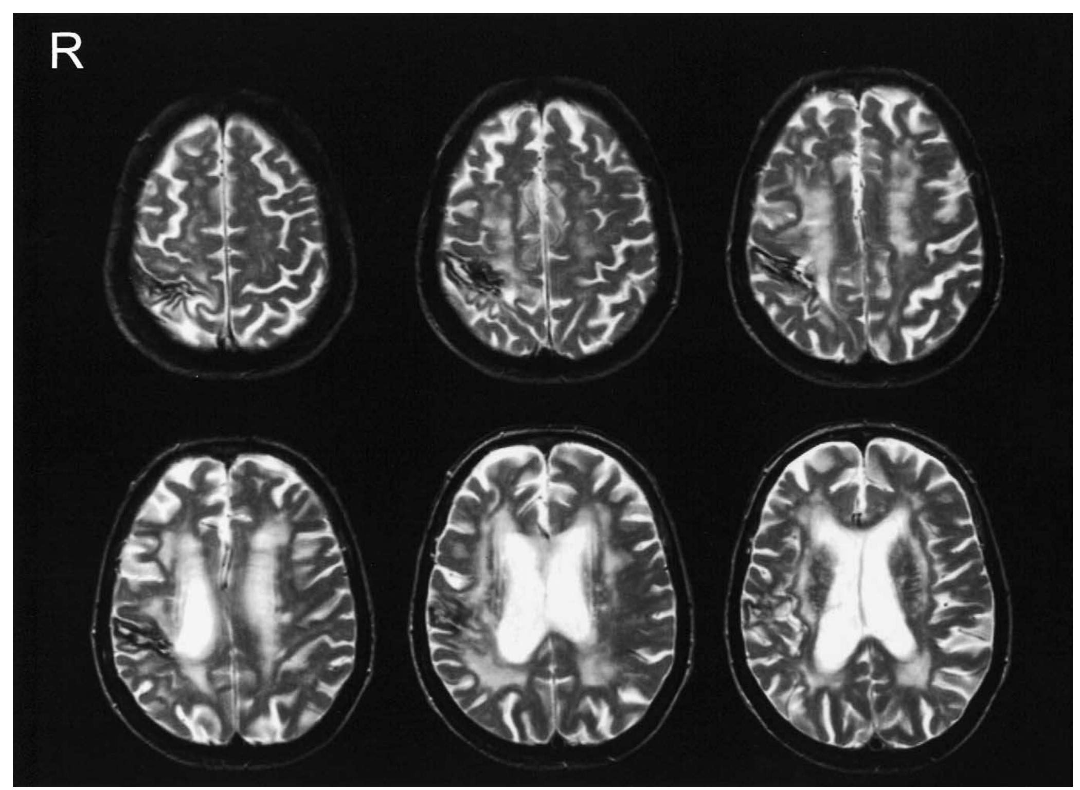 Axial t2-weighted mri images showing the residual damage to Axial t2-weighted mri images showing the residual damage to