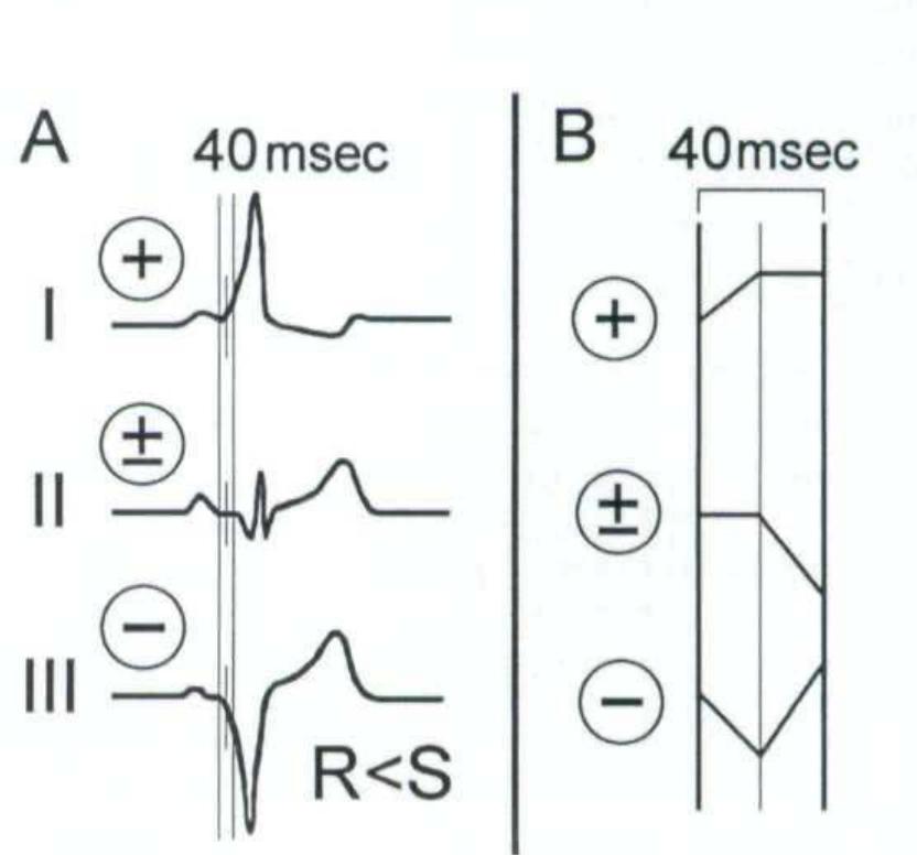 Step 3: lead v, is examined. a negative or iso- electric