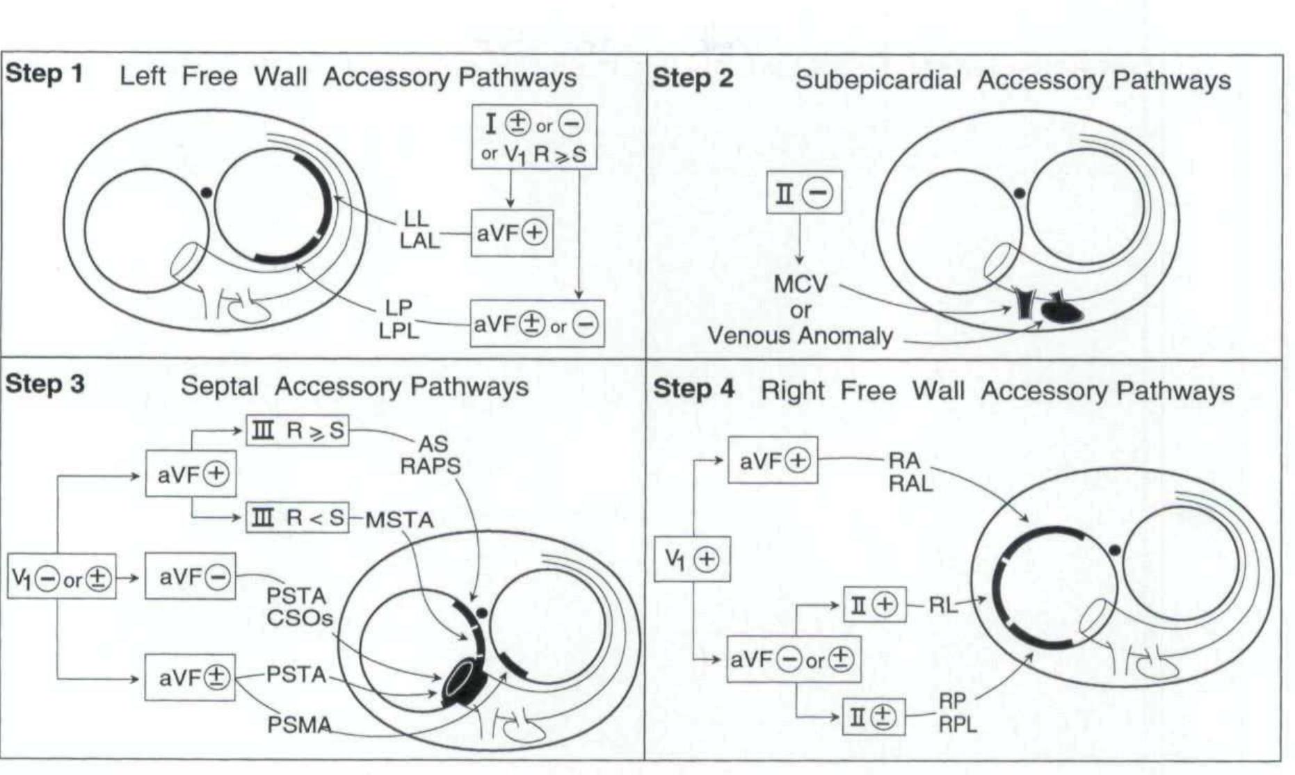 Stepwise ecg algorithm for predicting accessory pathway