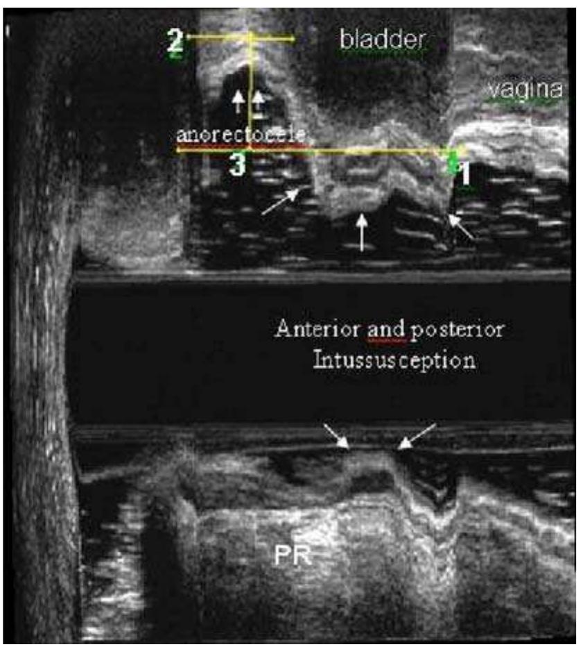Anorectocele grade iii (between lines 2 and 3) with anterior