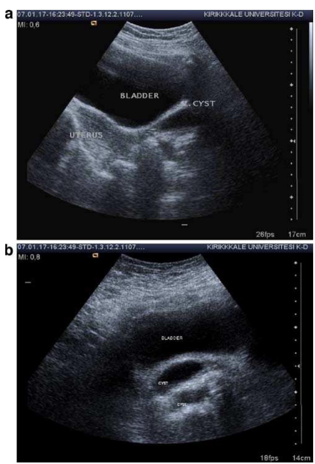 A initial pelvic ultrasound showing a vaginal cyst in