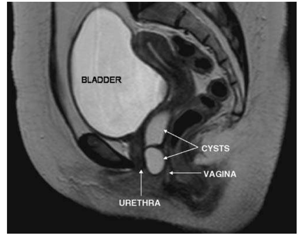 Pelvic mri scan of vaginal cysts localized to anterior