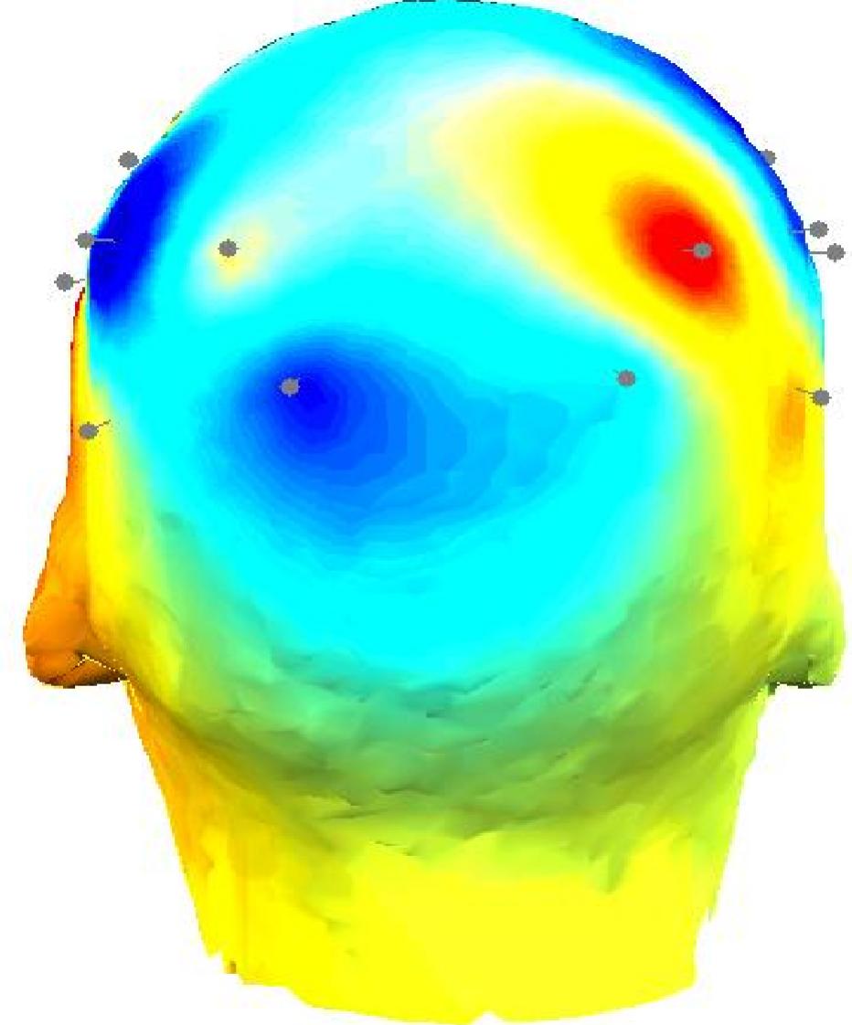 Topographic map of the difference of p300 amplitude in the