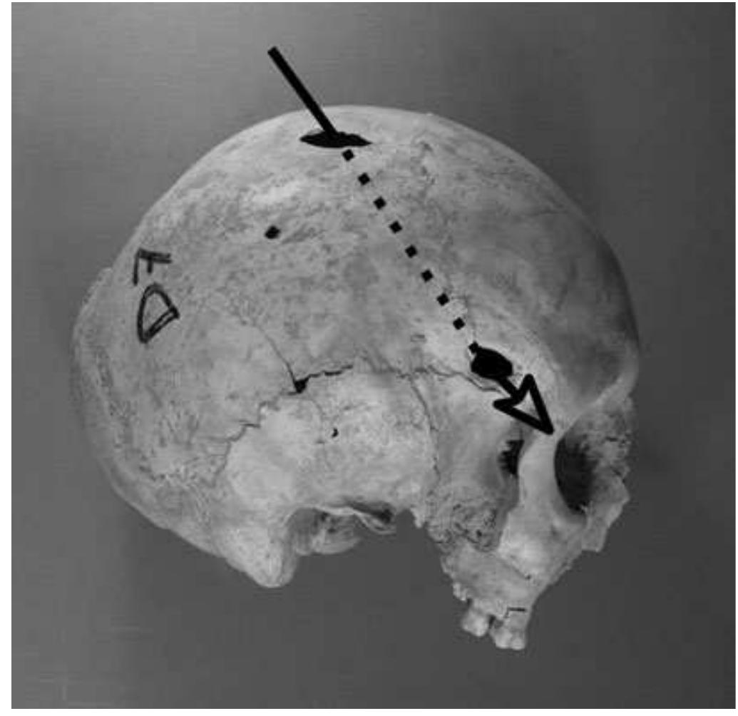 Skull trauma (individual d7), entry wound on the right