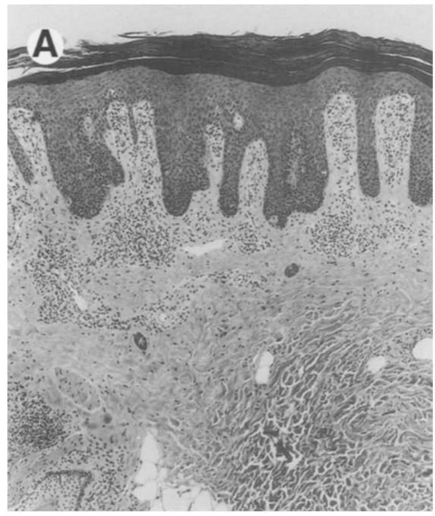 Figure 3 - Diagnosis: Psoriasis or not? What are the clues