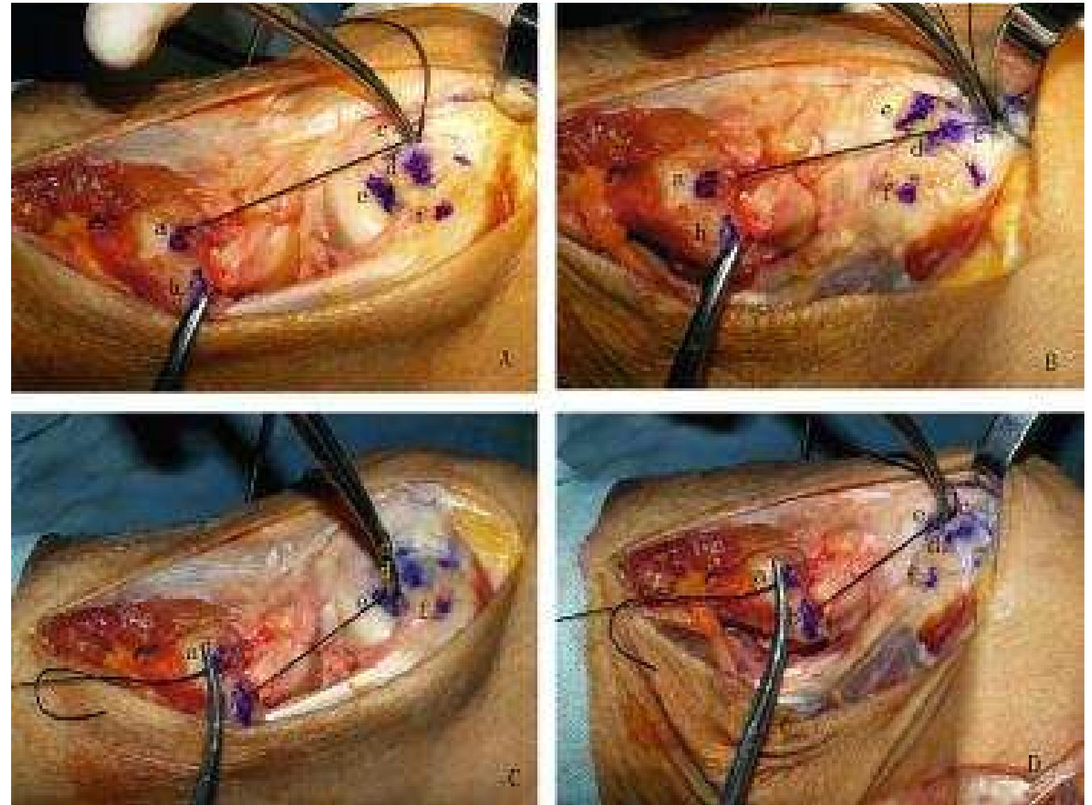 the fibular insertion of the lcl is isometric to the