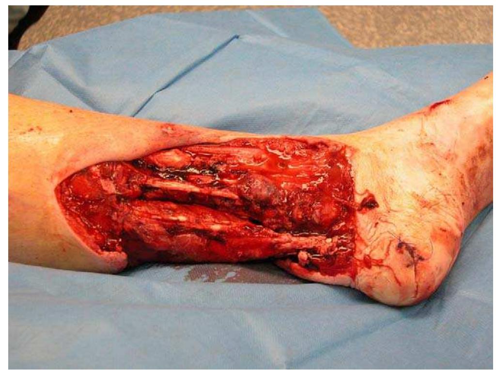 A grade iiib compound fracture with extensive skin and soft