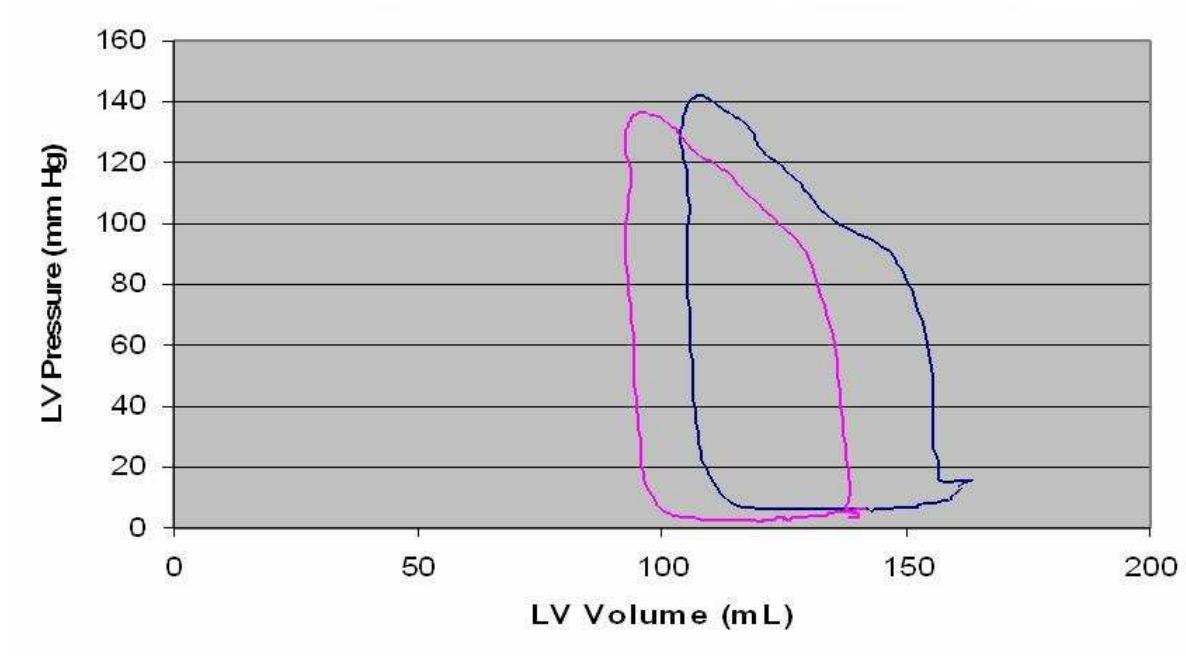 Pv loop of the heart of a patient with coronary artery