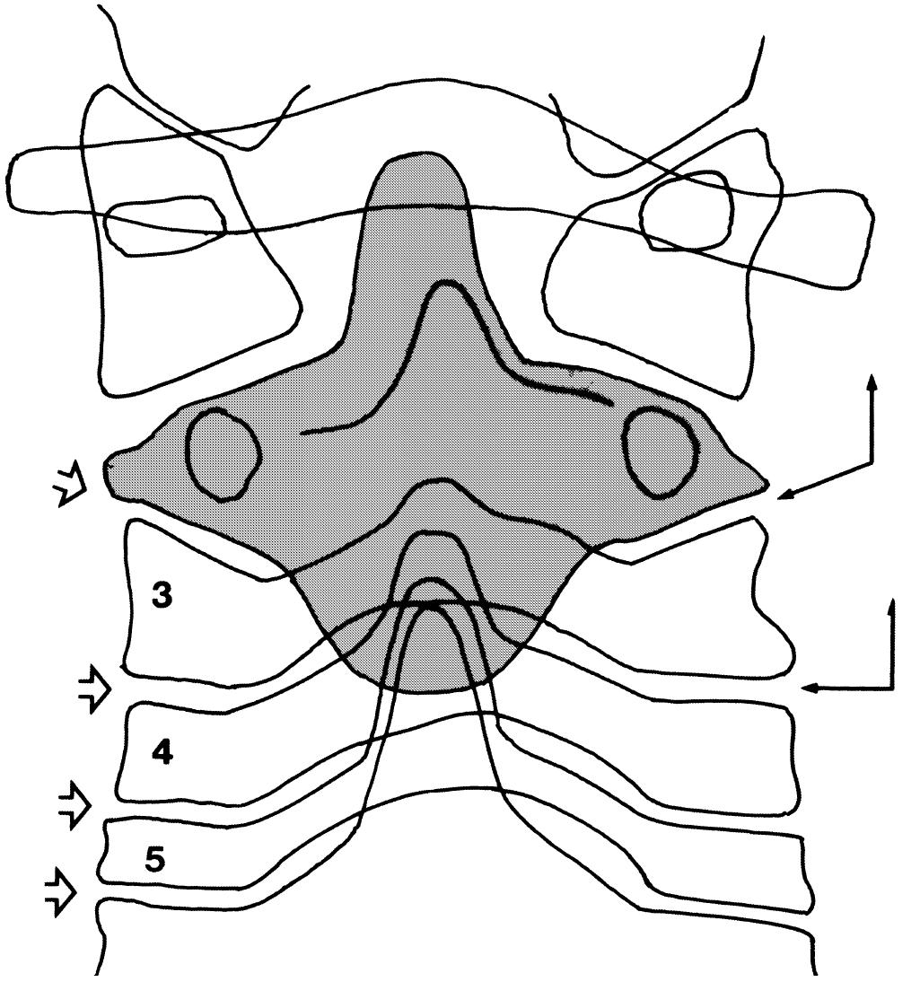 A tracing of a pillar view of the upper cervical spine,